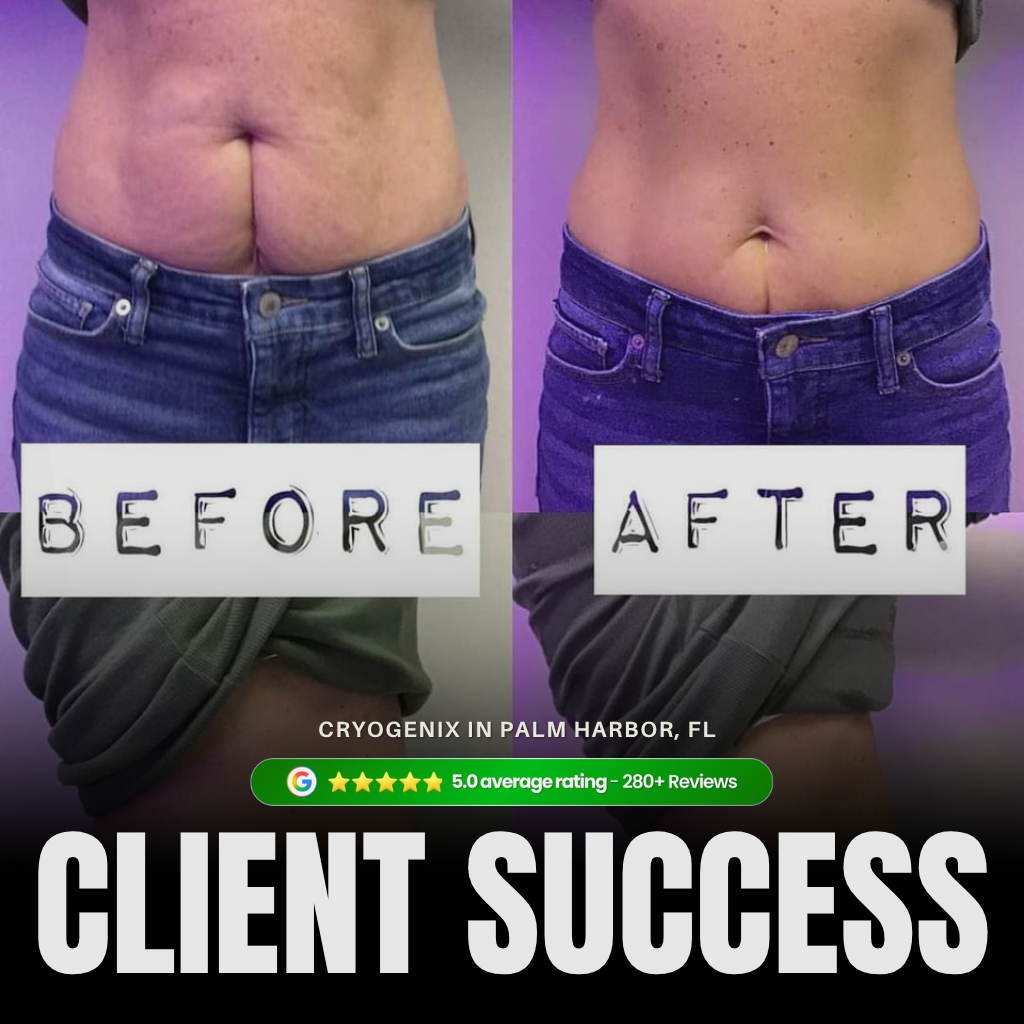 Laser-Lipo Palm Harbor FL - Non-Invasive Sculpting | Cryogenix